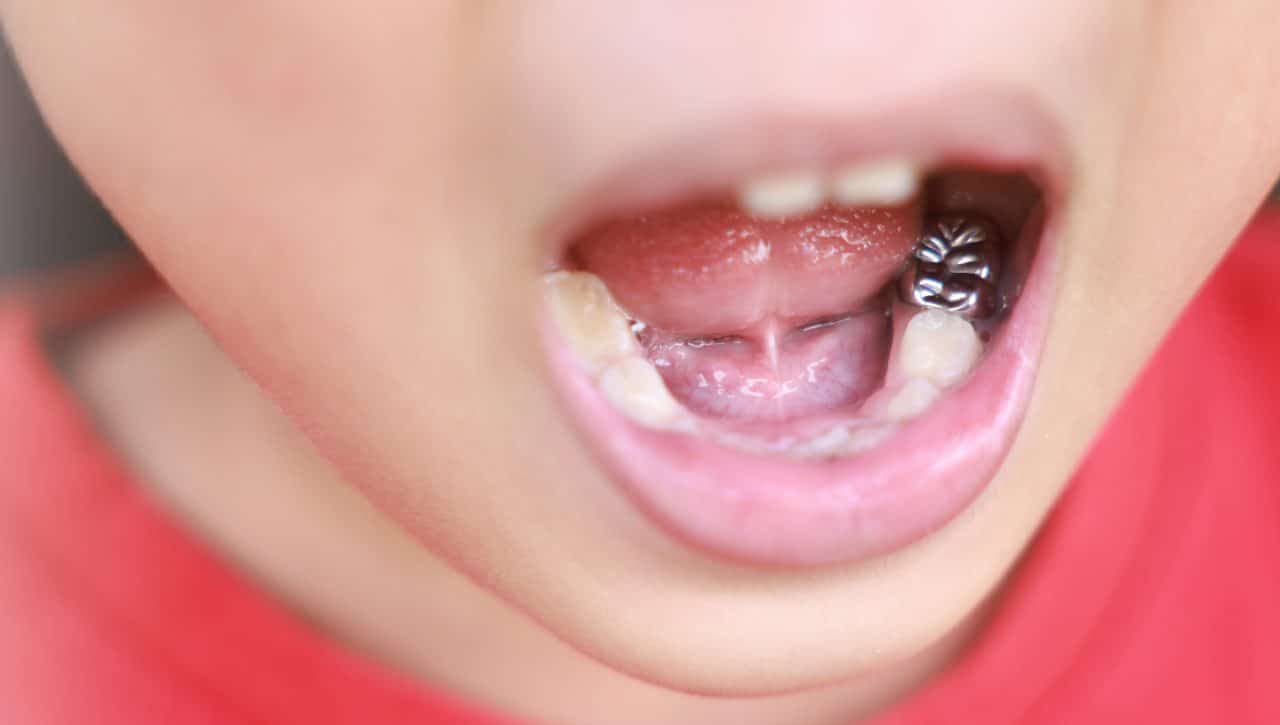 Pediatric White Crowns in Denver CO - Dental Caps for Kids